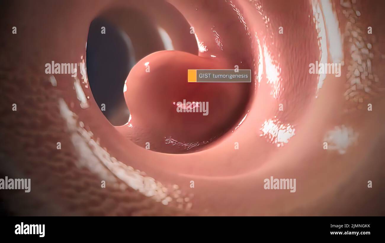 Intestine tumors hi-res stock photography and images - Alamy