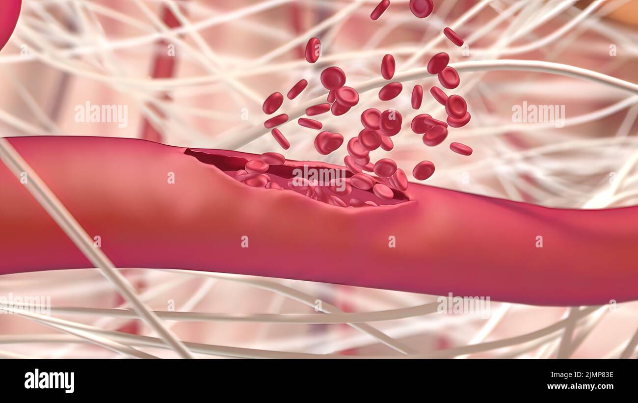 Severe Bleeding Trauma