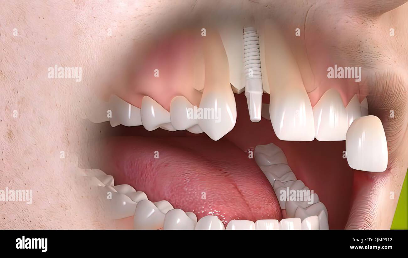 Dental crown surgery hi-res stock photography and images - Alamy