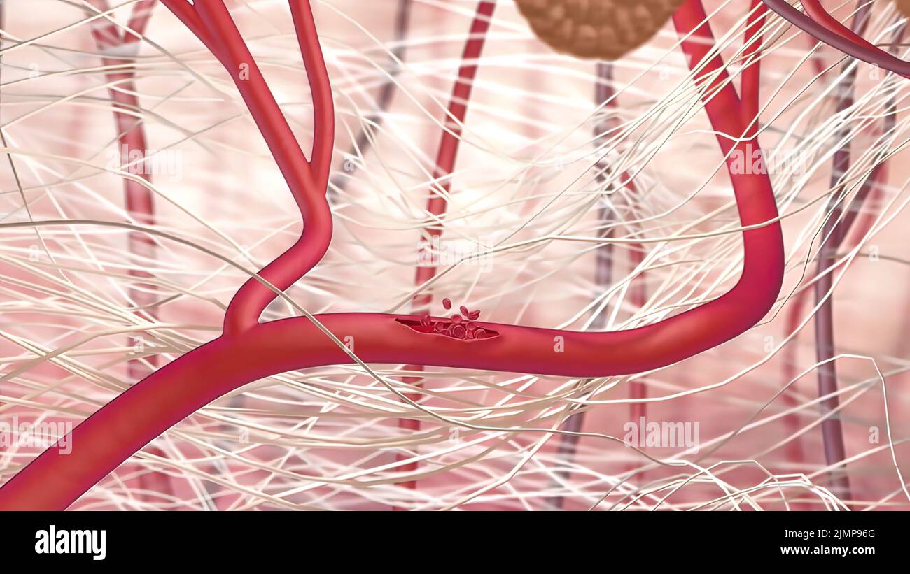 Stomach bleeding hi-res stock photography and images - Alamy