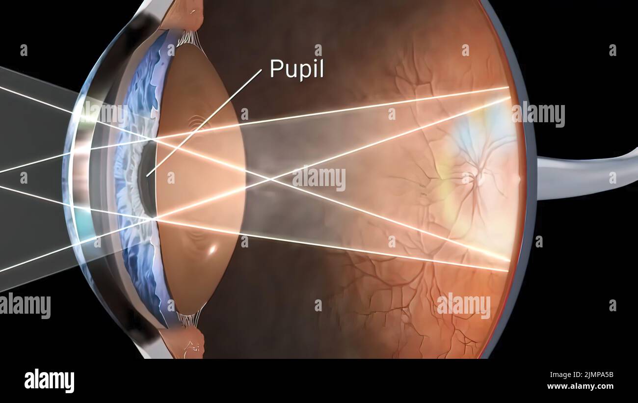 Anterior chamber eye hi-res stock photography and images - Alamy