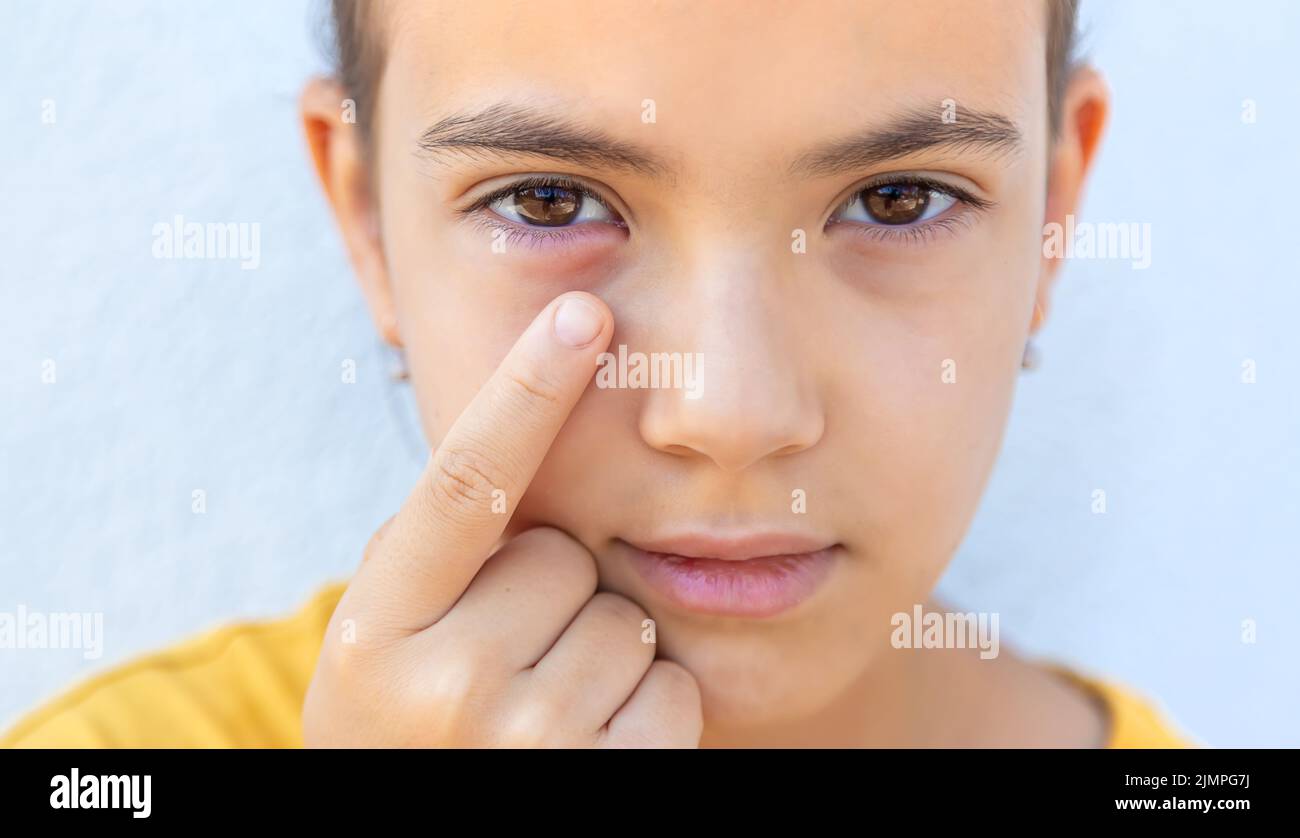 The child eye is inflamed. Selective focus. Kid Stock Photo - Alamy