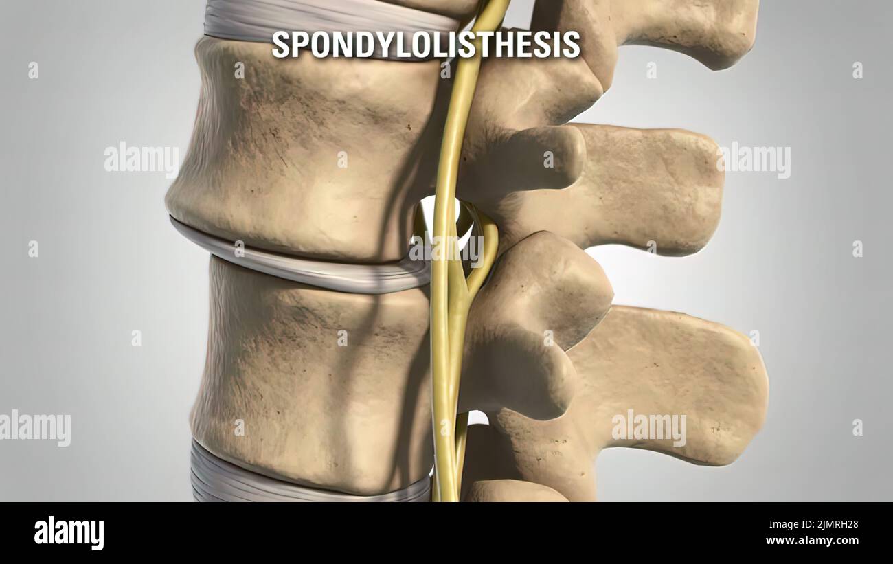 Degenerative disc disease hi-res stock photography and images - Alamy