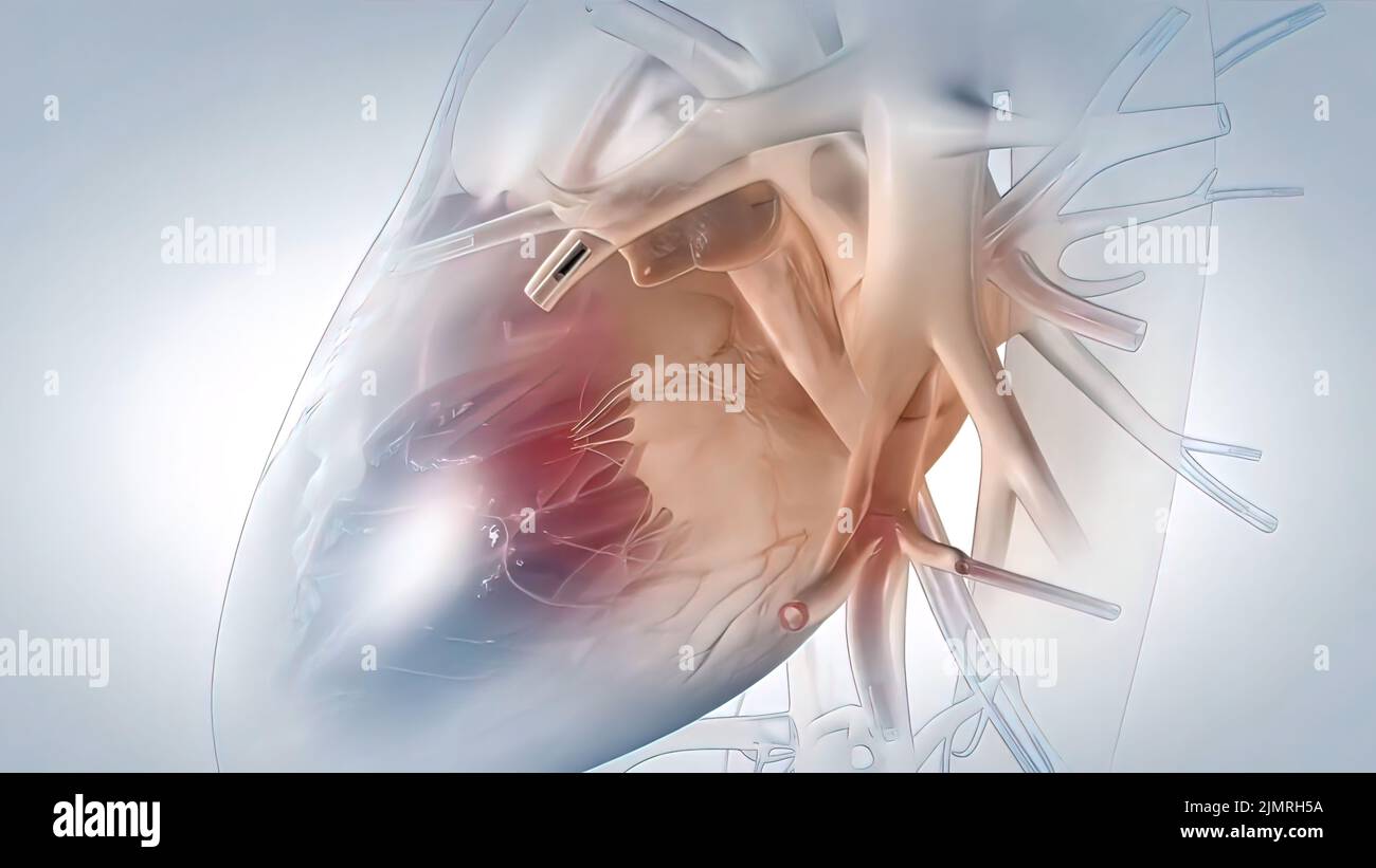 Aorta heart failure hi-res stock photography and images - Alamy