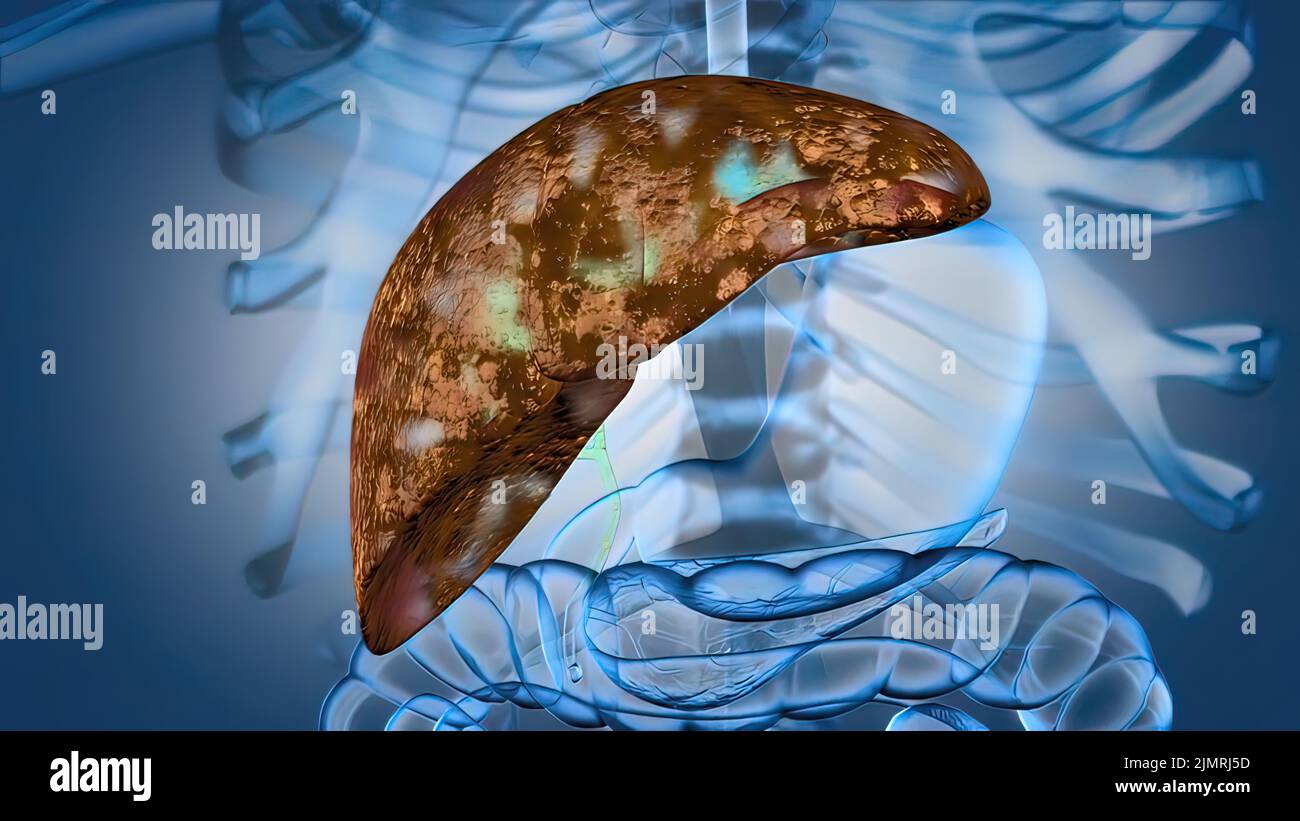 Liver failure hi-res stock photography and images - Alamy
