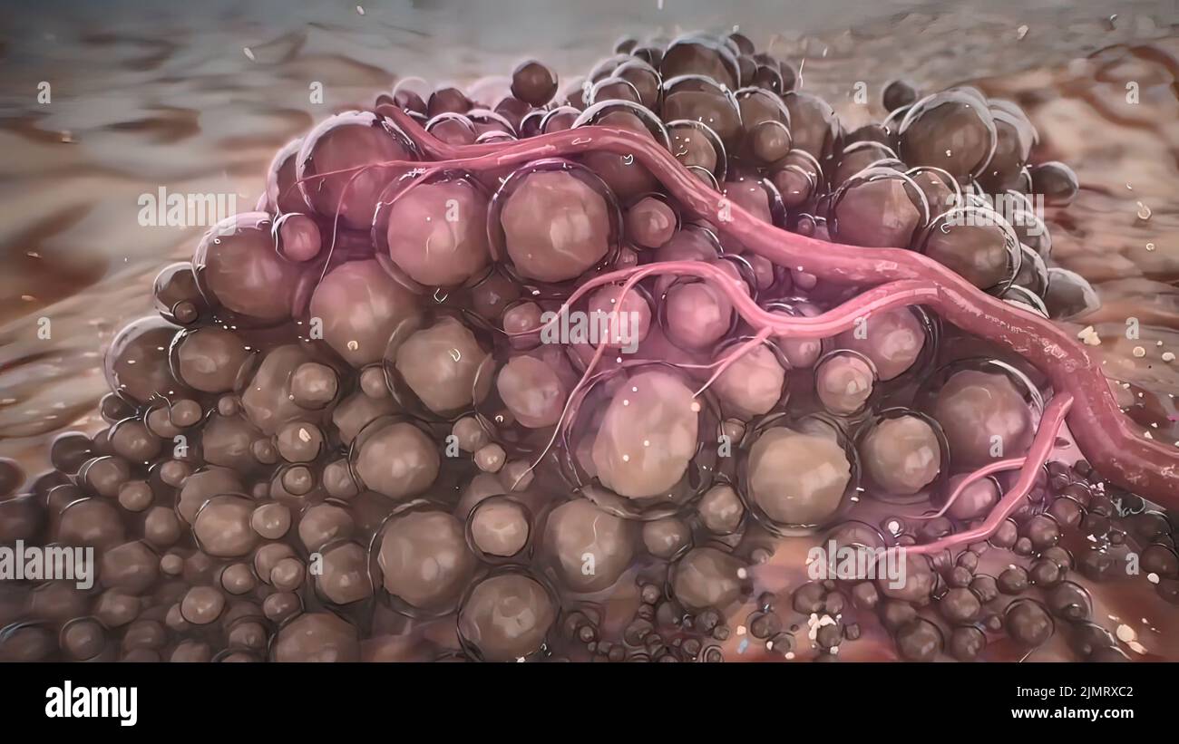 Advanced stomach cancer hi-res stock photography and images - Alamy