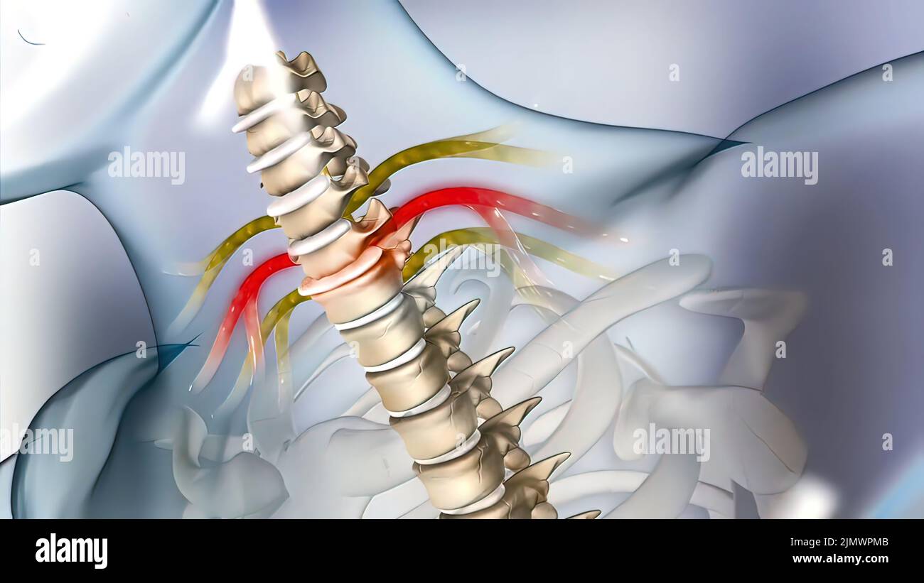 Lumbar vertebra compress hi-res stock photography and images - Alamy