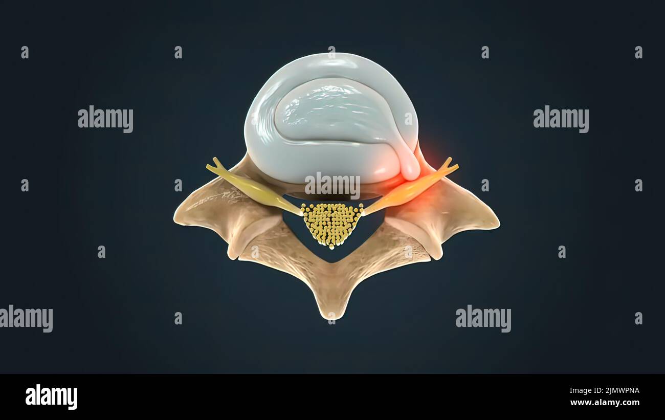 Spinal cord lamina hi-res stock photography and images - Alamy