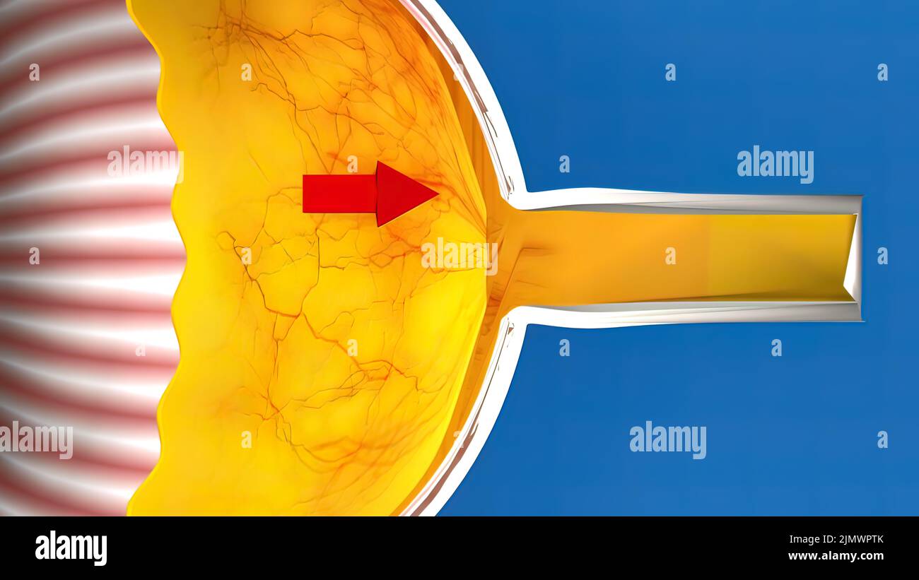 3D Medical Animated Normal Tension Glaucoma on Blue Background Stock ...