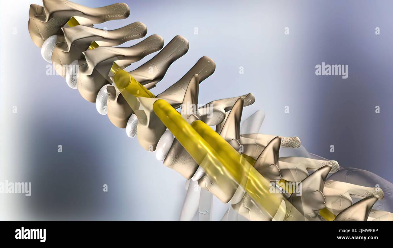 Lumbar compress hi-res stock photography and images - Alamy