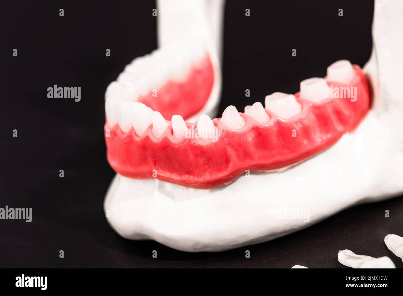 Teeth implant and crown installation process parts isolated on a black ...