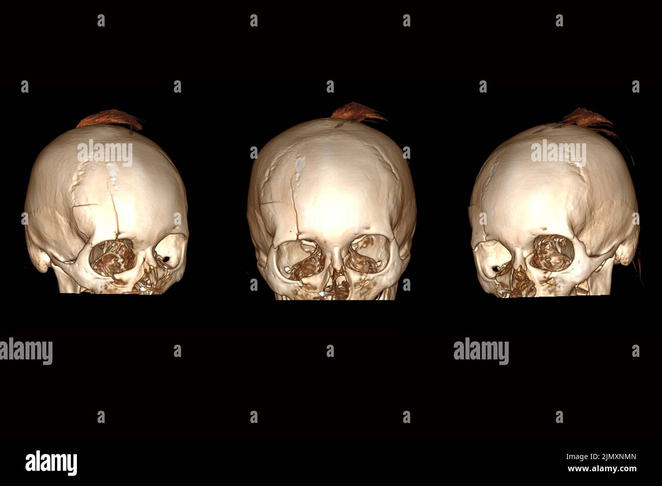 3d computed tomography of the brain with a fracture of the frontal part ...