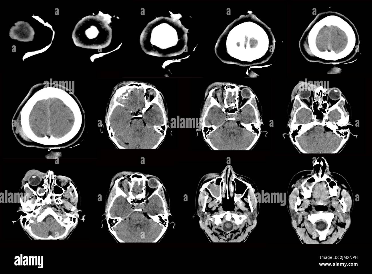 computed tomography of the brain with a fracture of the frontal part of ...