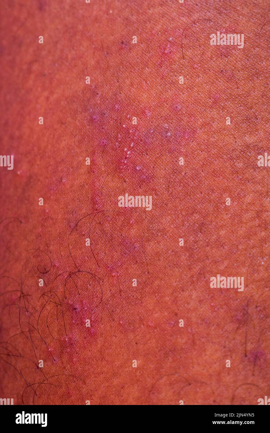 Skin rashes hi-res stock photography and images - Alamy