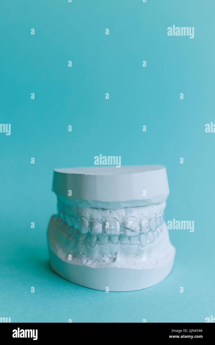 Plaster model of human teeth with transparent aligner, essix retainer ...