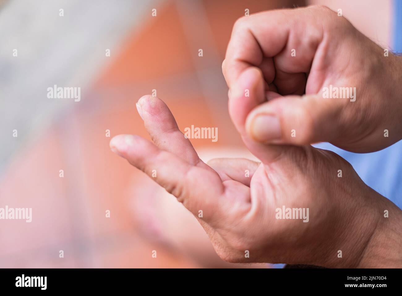 First degree burn hi-res stock photography and images - Alamy