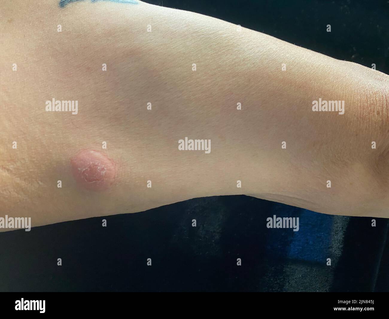 Cutaneous t-cell lymphoma Stock Photo - Alamy