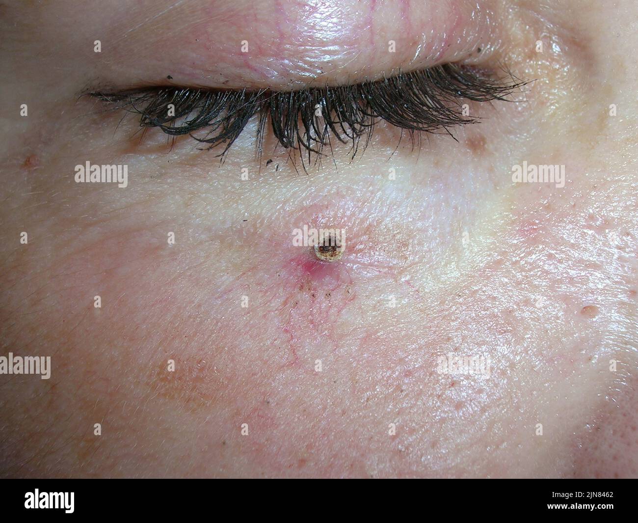 Spider angioma after electrosurgery Stock Photo - Alamy