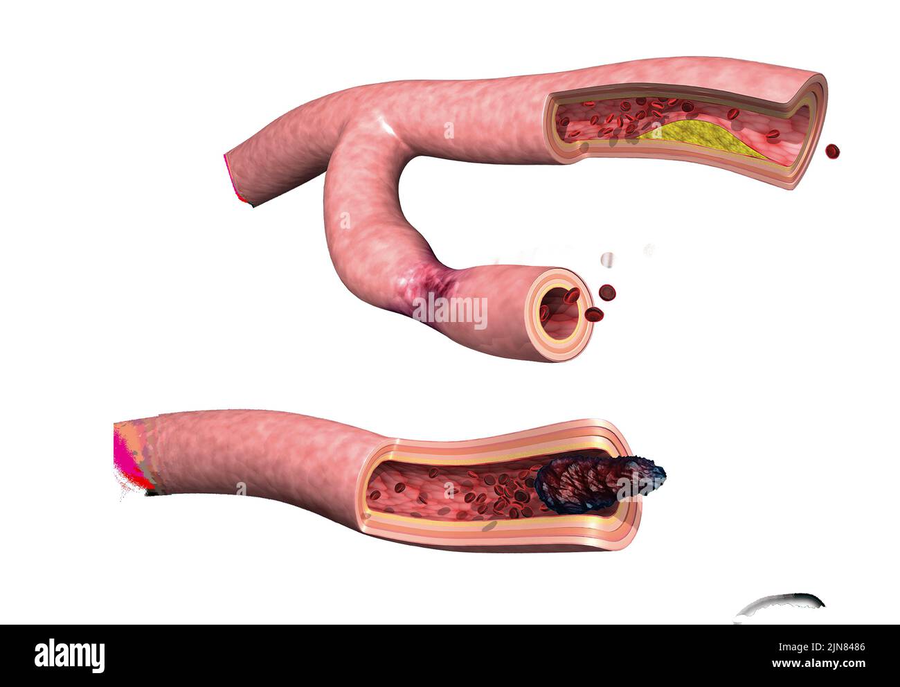 Blood clot, illustration Stock Photo - Alamy