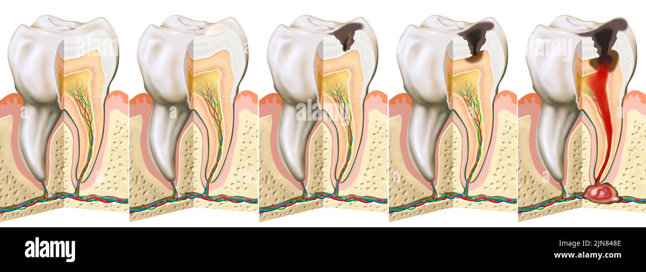 Stages of tooth decay, illustration Stock Photo - Alamy