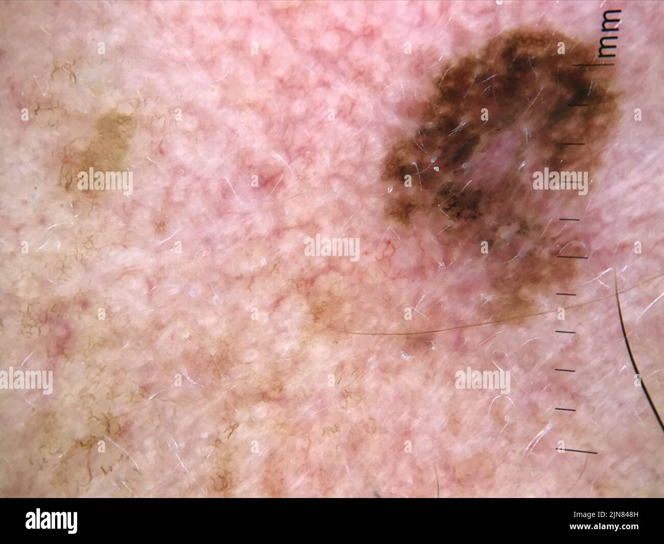 Melanoma in situ, dermoscopy Stock Photo - Alamy
