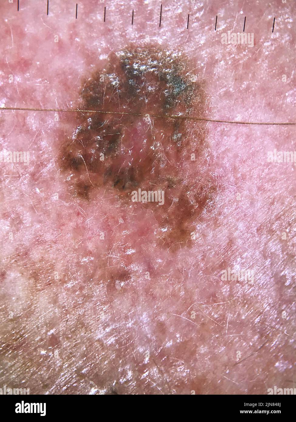 Melanoma in situ, dermoscopy Stock Photo - Alamy