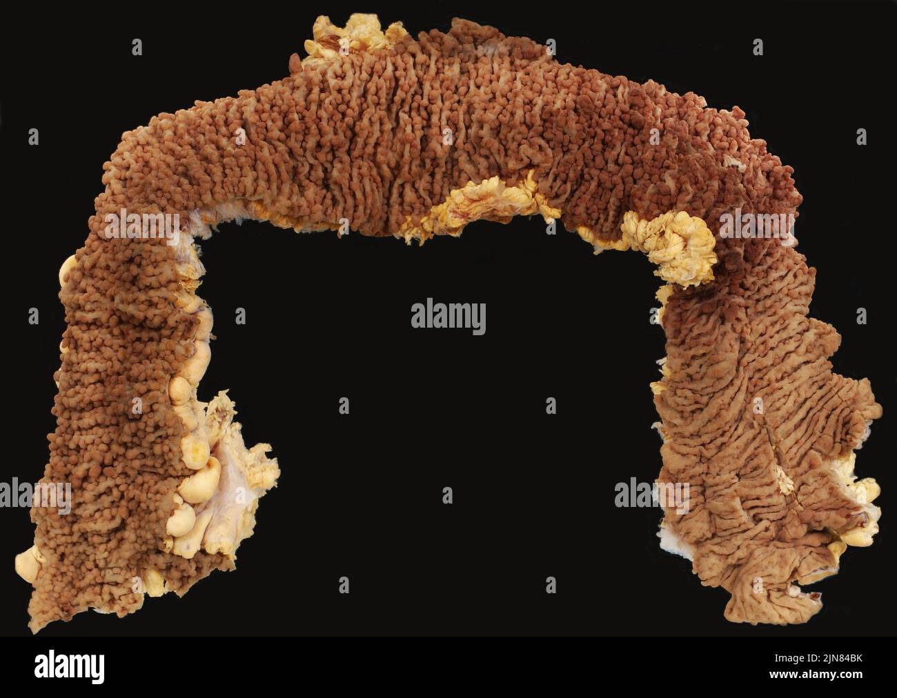 Colon polyps, gross specimen Stock Photo - Alamy