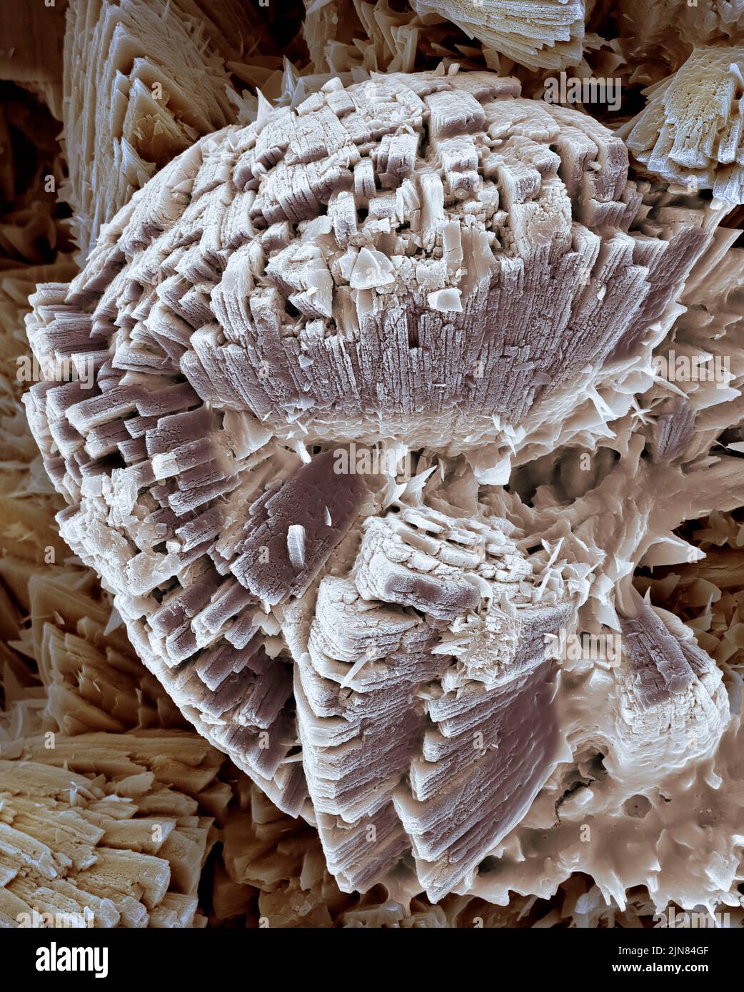 Kidney stone, SEM Stock Photo - Alamy