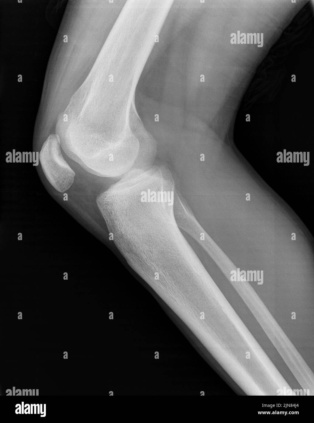 Synovitis of the knee, X-ray Stock Photo - Alamy