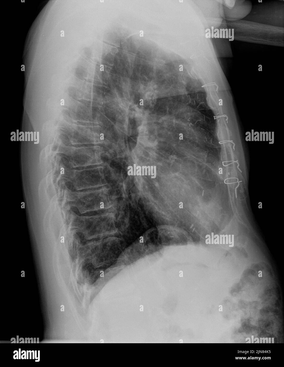 Sternotomy surgery, X-ray Stock Photo - Alamy
