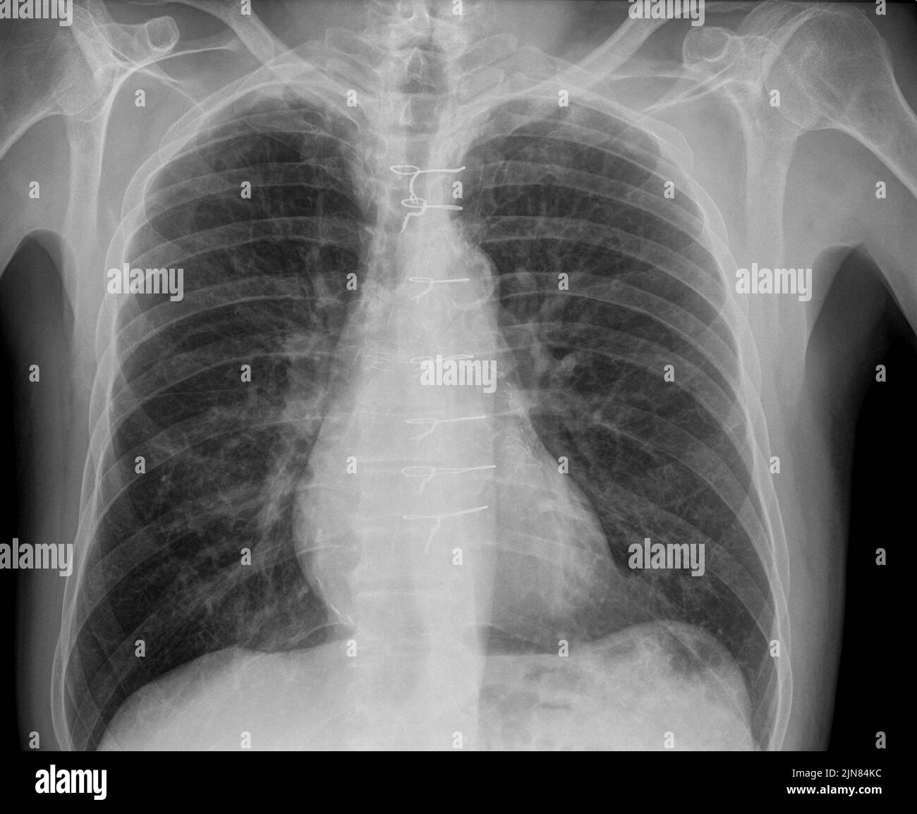 Sternotomy surgery, X-ray Stock Photo - Alamy