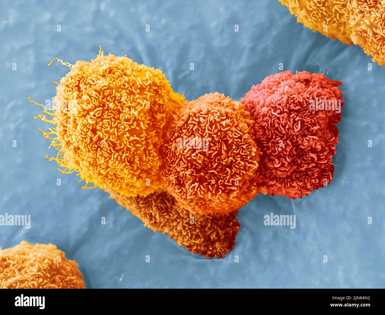 Pancreatic cancer cells, SEM Stock Photo - Alamy
