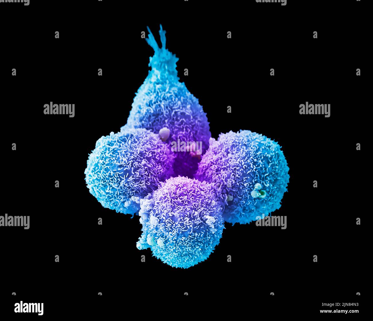 Lung cancer cells, SEM Stock Photo - Alamy