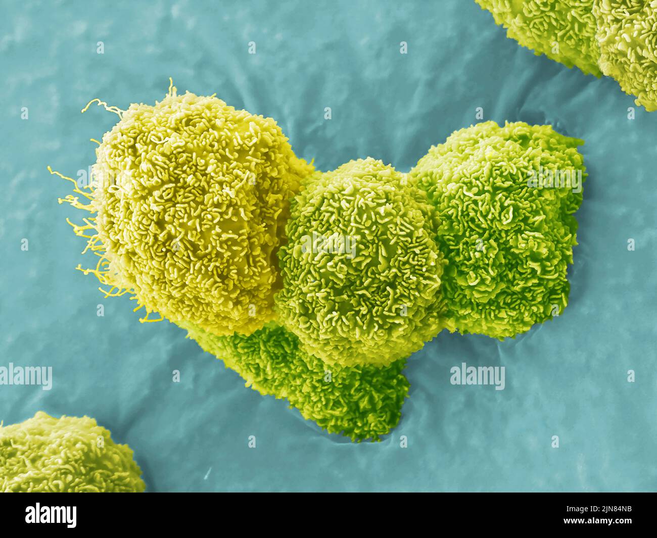 Pancreatic cancer cells, SEM Stock Photo - Alamy