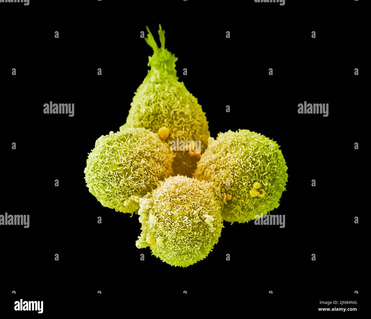 Lung cancer cells, SEM Stock Photo - Alamy