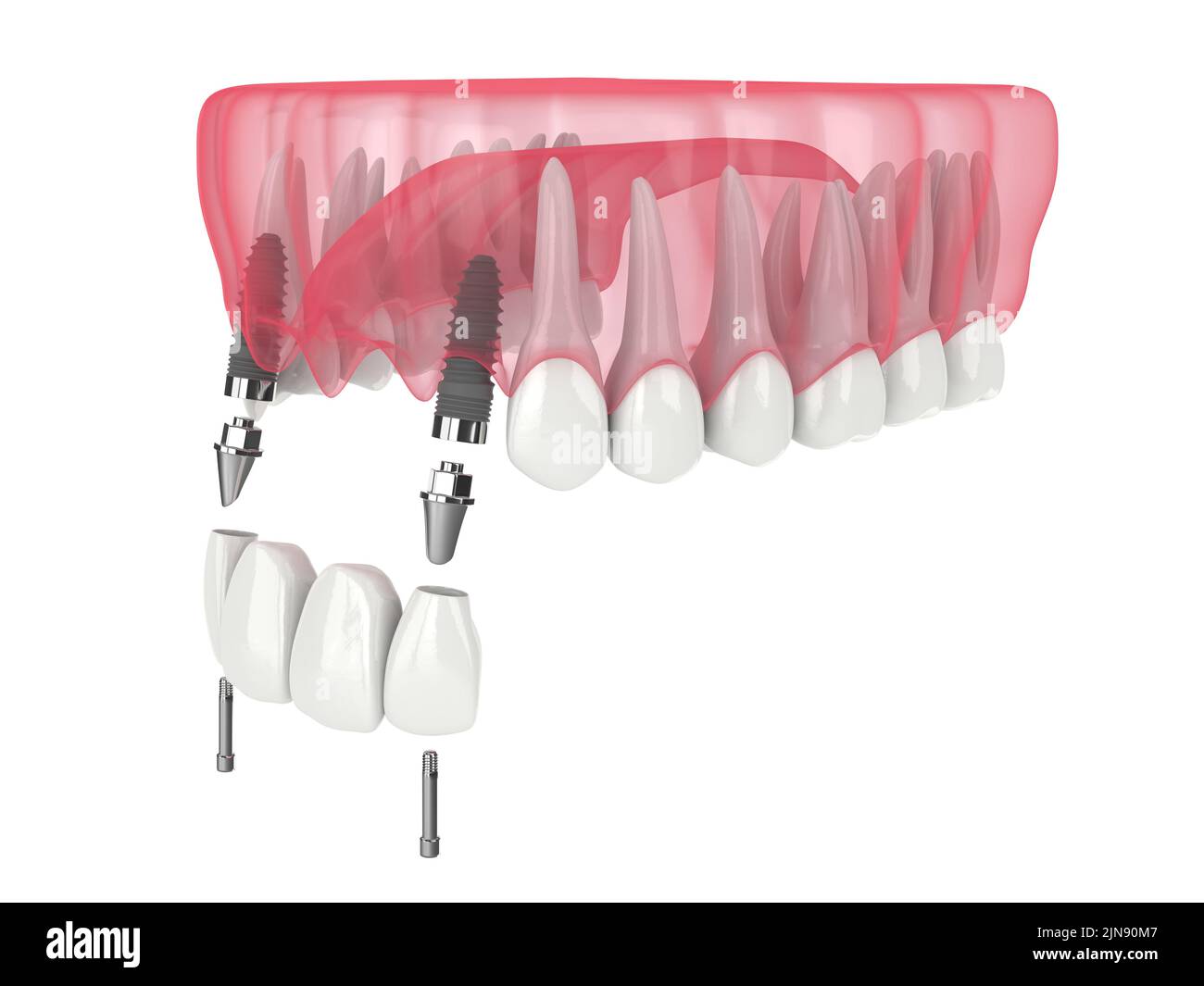 3d render of jaw with dental incisors bridge supported by implants over ...