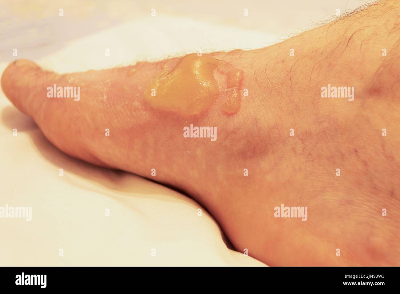 Severe Burn And Blister On Legs Close Up Not Bursting The Blister On The Feet Of An Adult