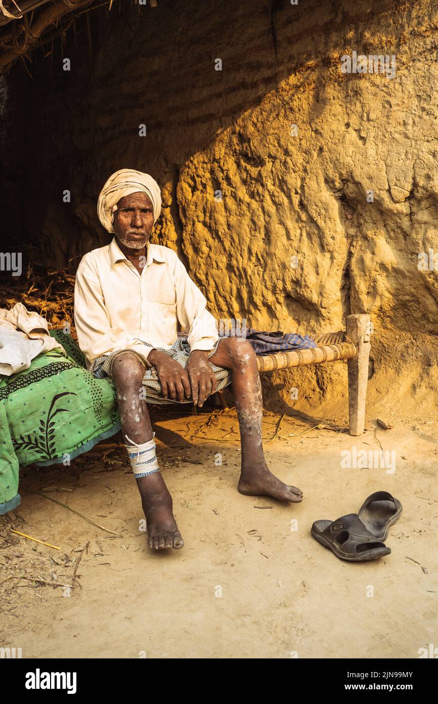 filariasis patient abnormal lymphatic function patient Stock Photo - Alamy