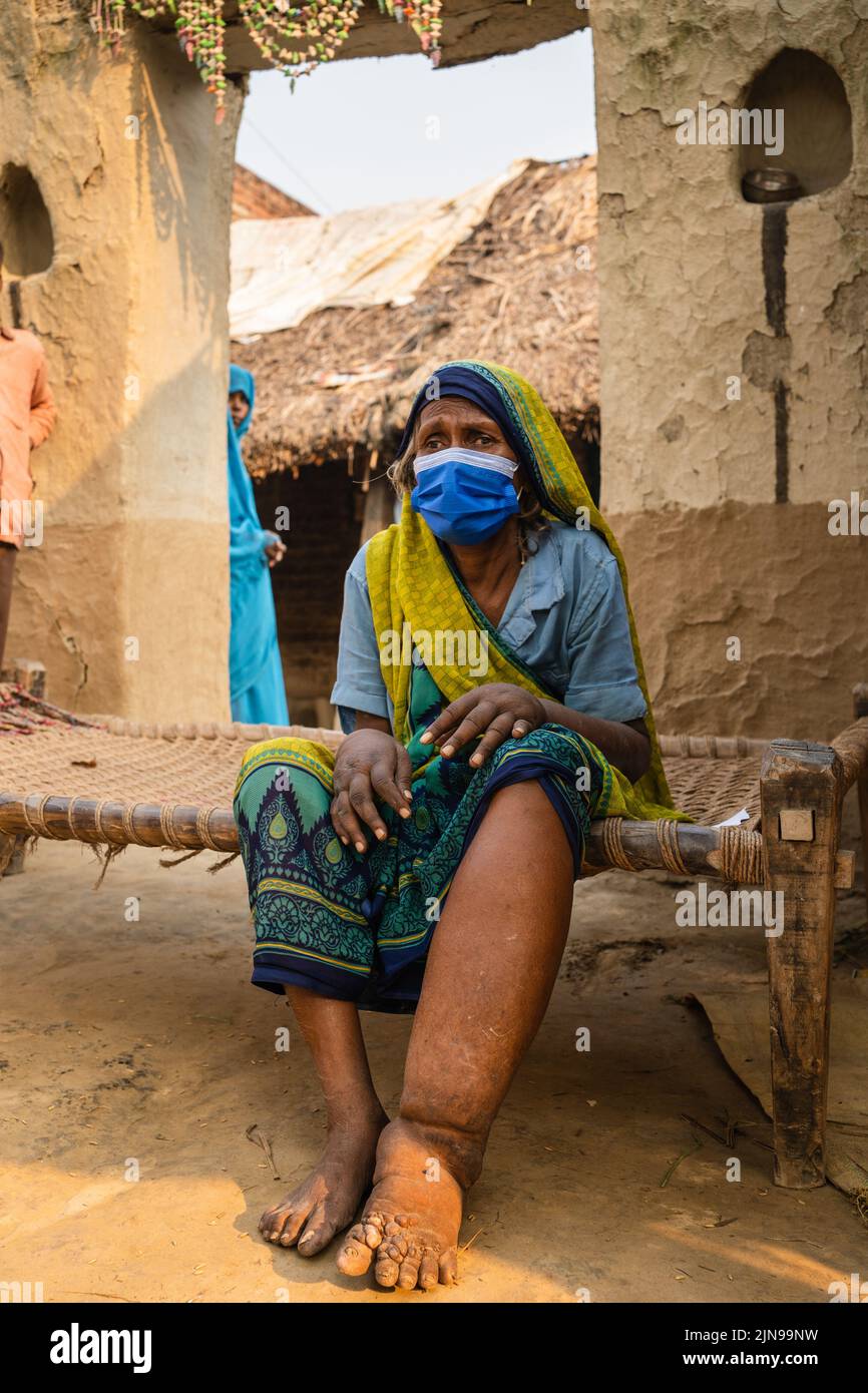 Filariasis is an infectious tropical disease caused by any one of ...