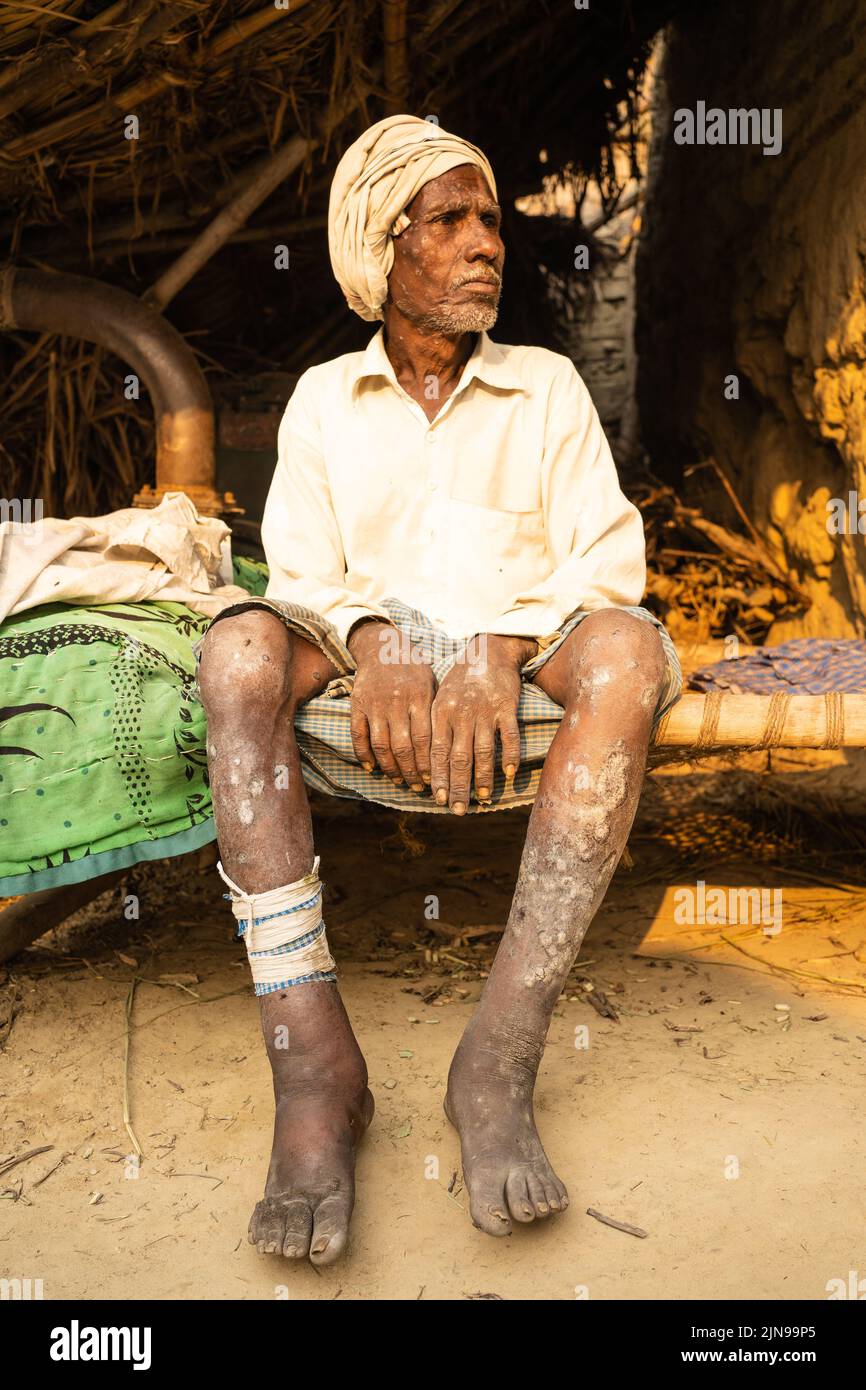 filariasis patient abnormal lymphatic function patient Stock Photo - Alamy