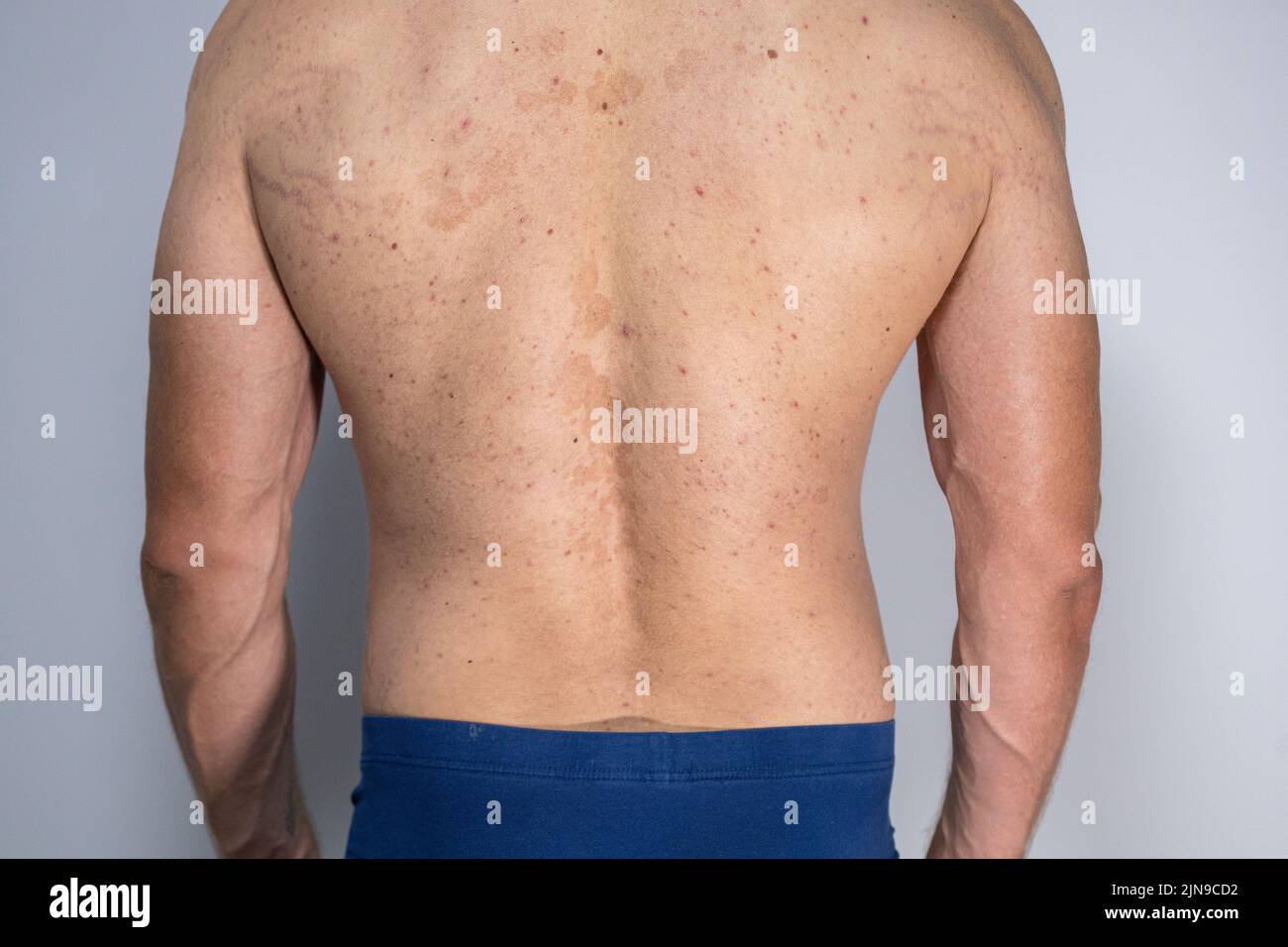 tinea versicolor on the back. pityriasis versicolor problem with skin ...
