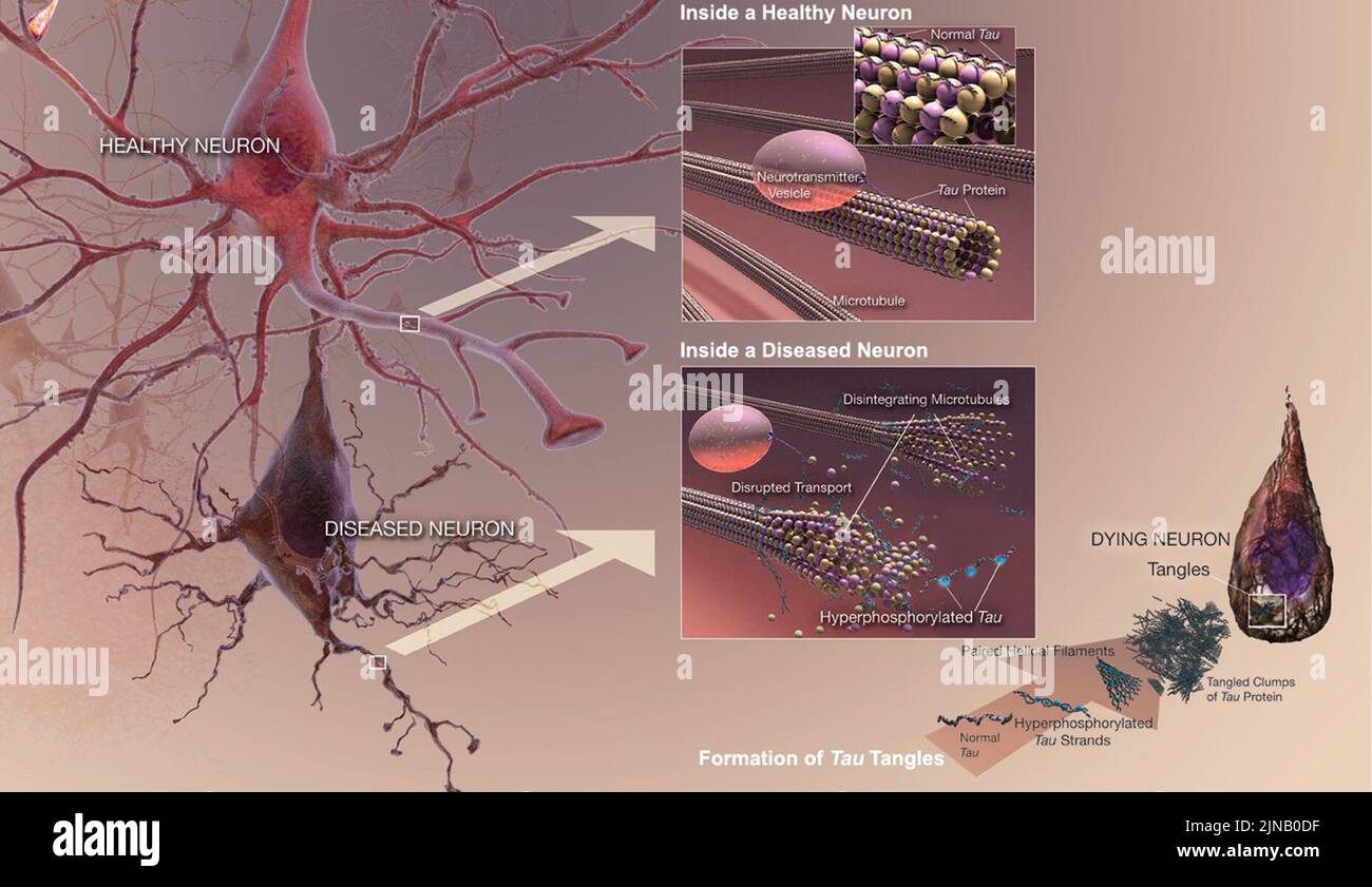 Tau tangle formation Stock Photo - Alamy