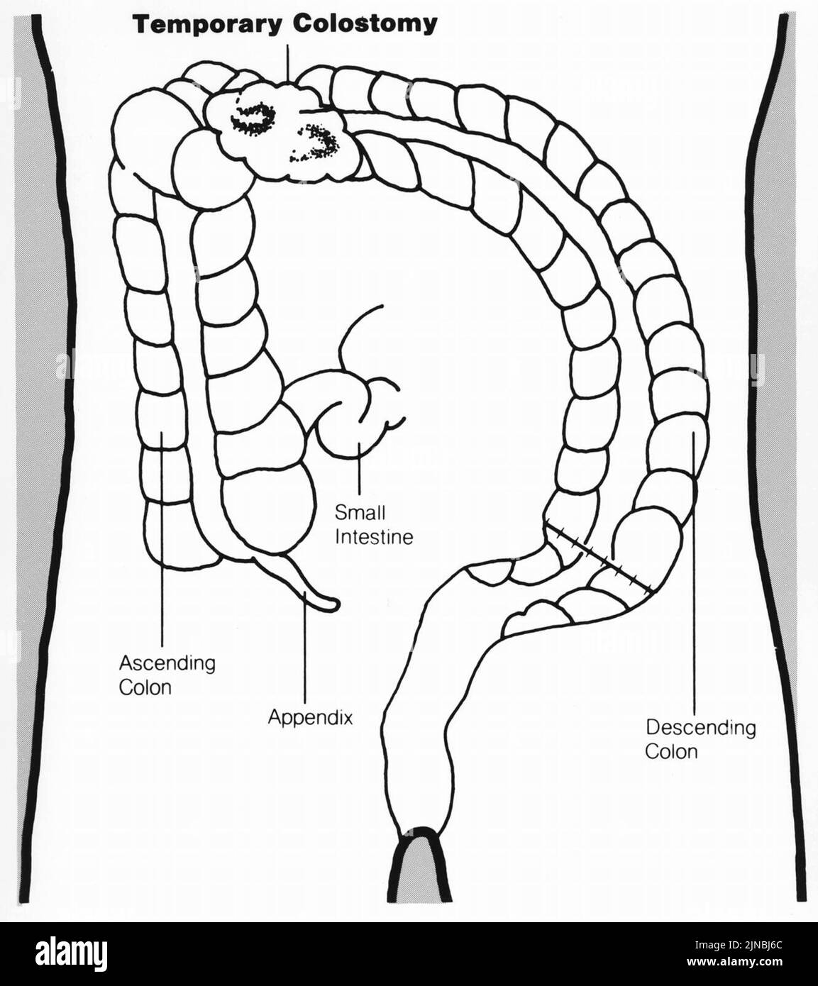 Colostomy Cut Out Stock Images & Pictures - Alamy