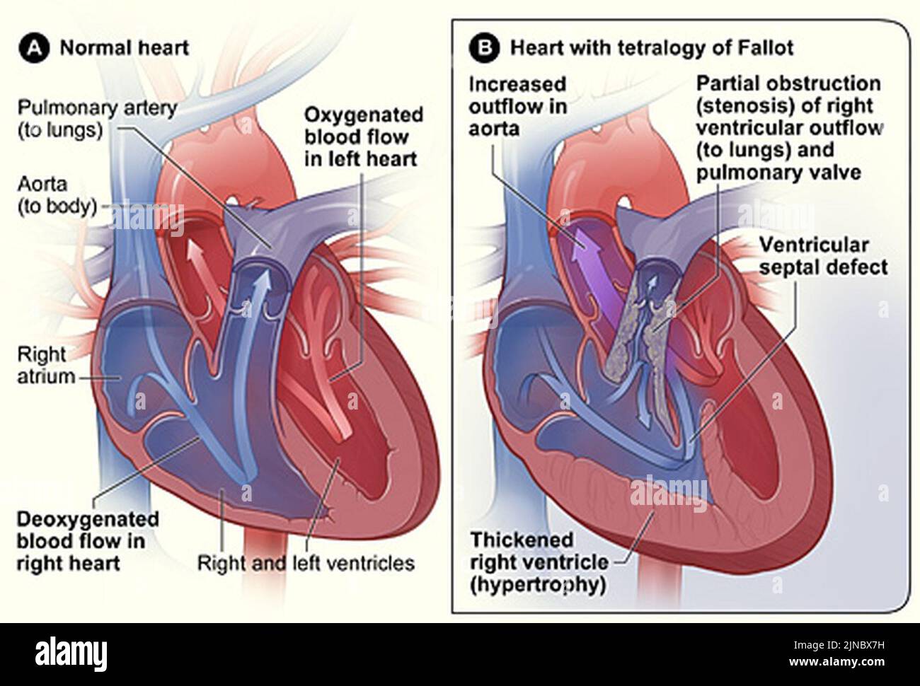 Tetralogy of fallot hi-res stock photography and images - Alamy