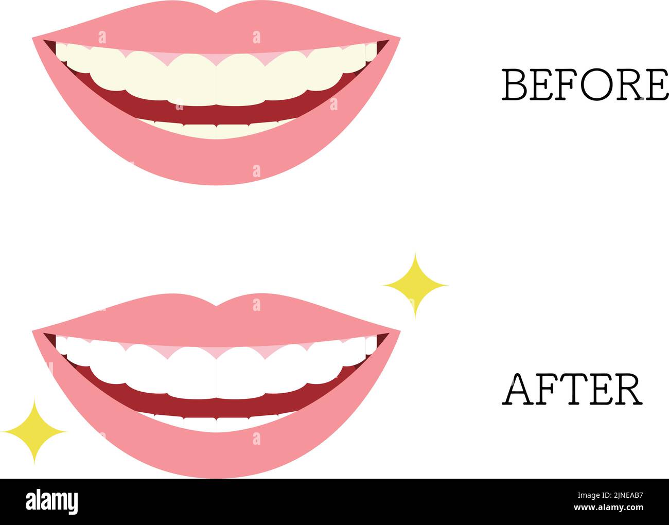 Aesthetic dentistry, illustration of yellowed teeth and white teeth ...