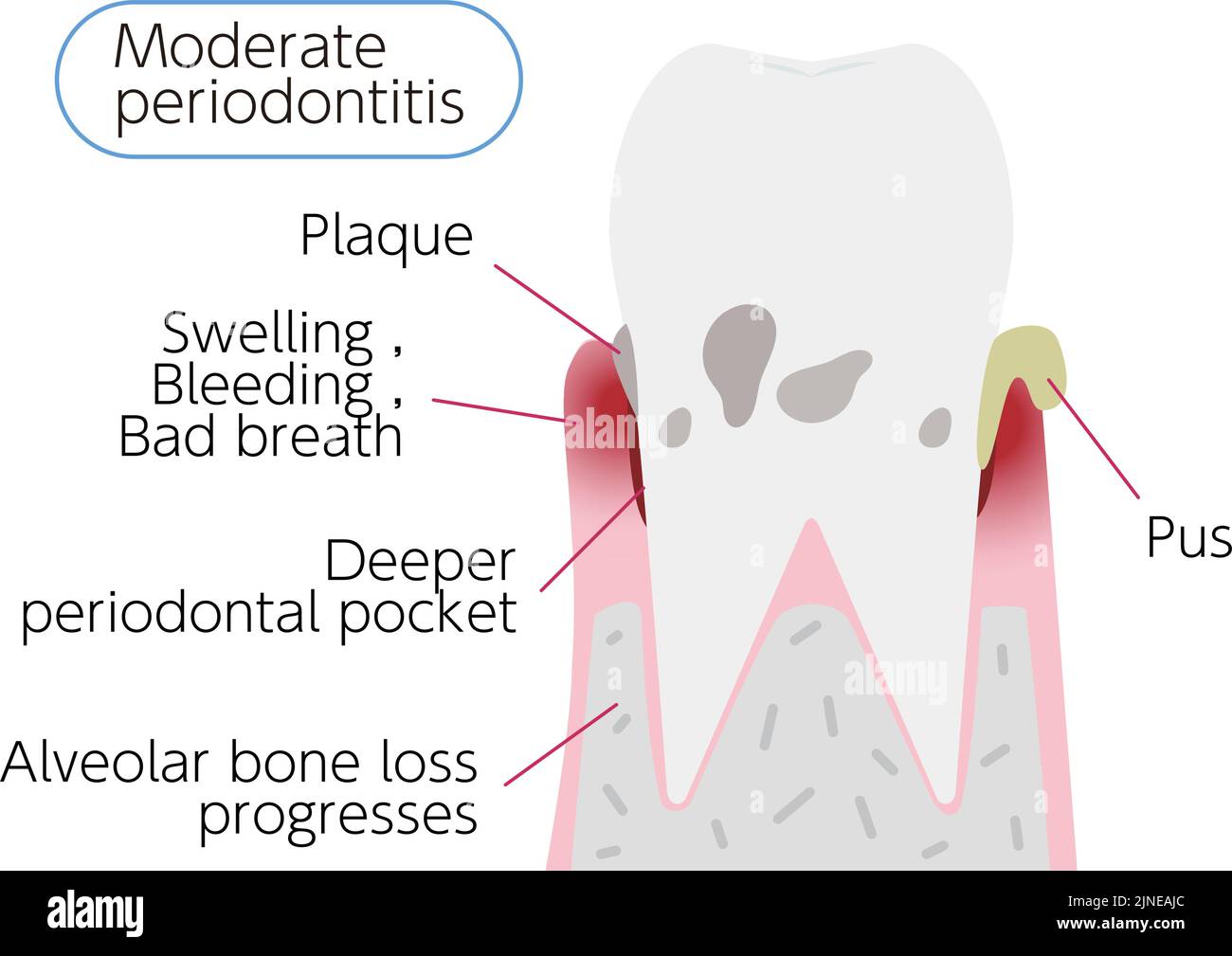 Illustration by stage of periodontal disease: moderate periodontitis ...