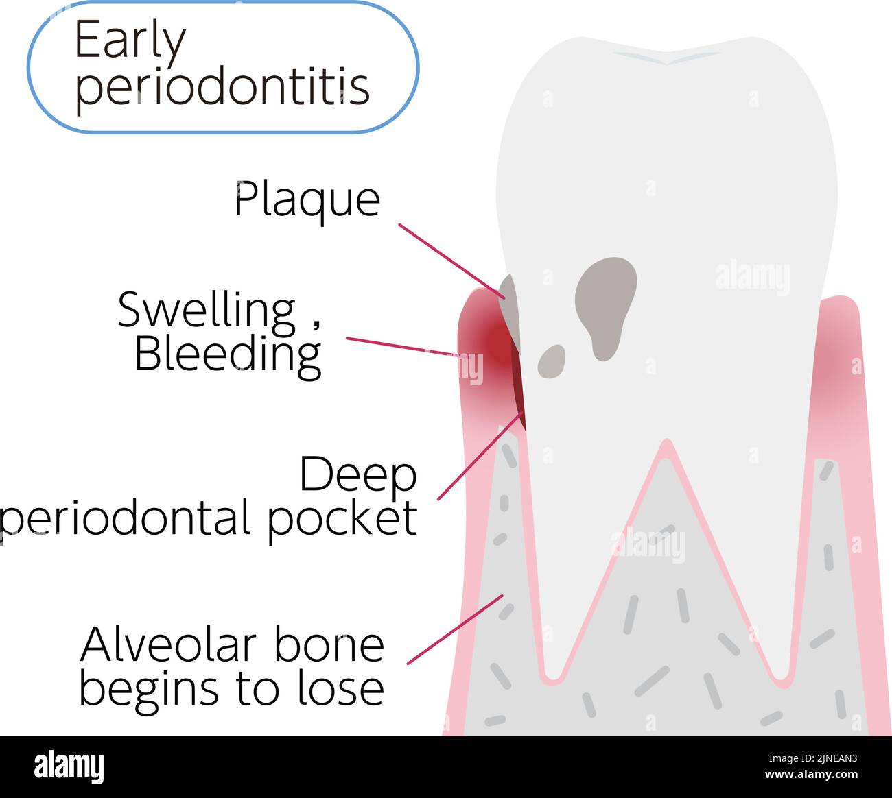 Illustration by stage of periodontal disease: early periodontitis Stock ...