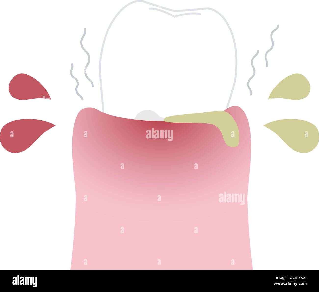 Illustration by stage of periodontal disease: severe periodontitis ...