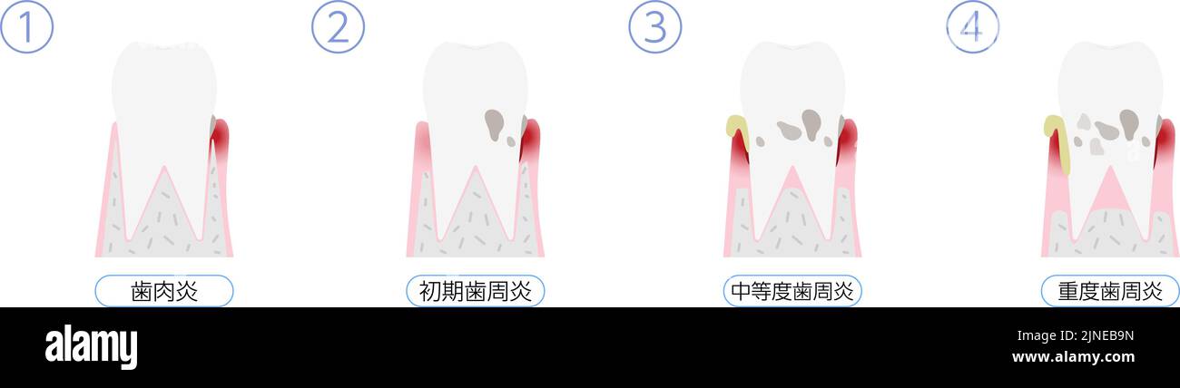 Periodontal disease progression illustration, 4 stages Translation ...
