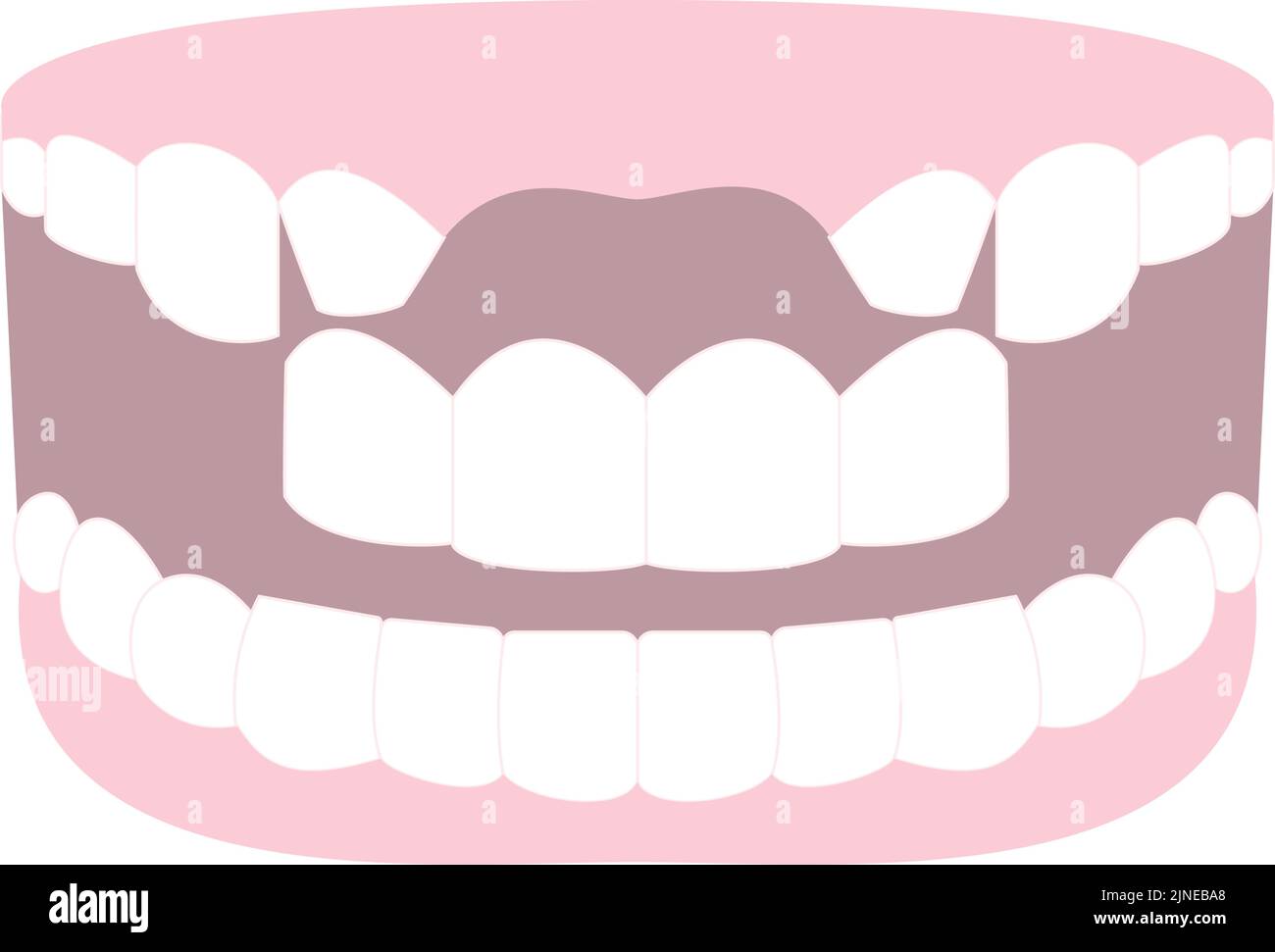 Illustration of a tooth bridging the missing front tooth Stock Vector ...